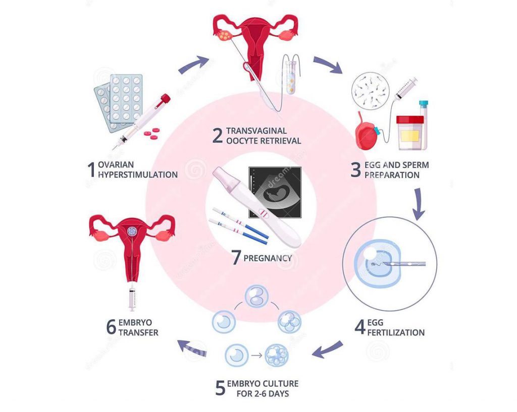 ICSI – Finney Hospital & Fertility Centre