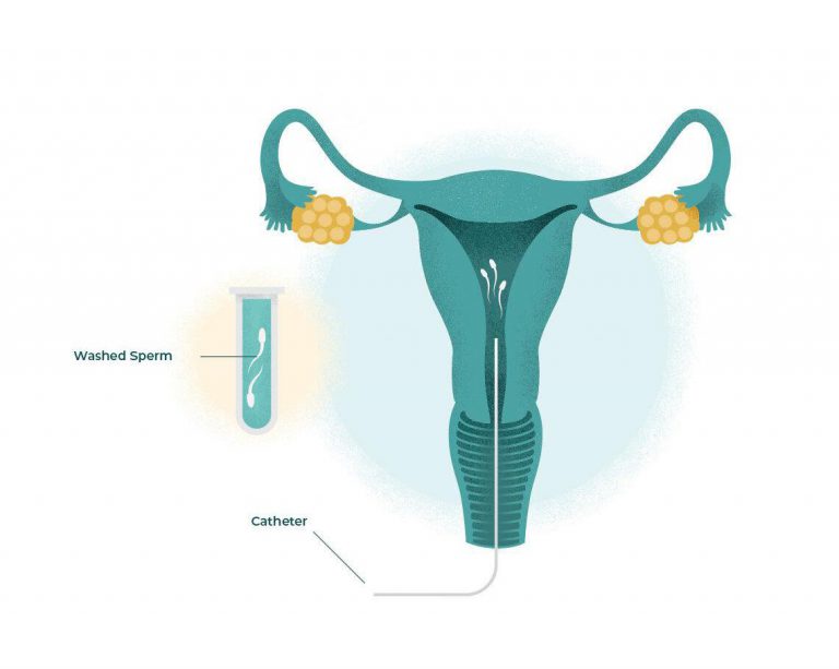 IUI – Finney Hospital & Fertility Center